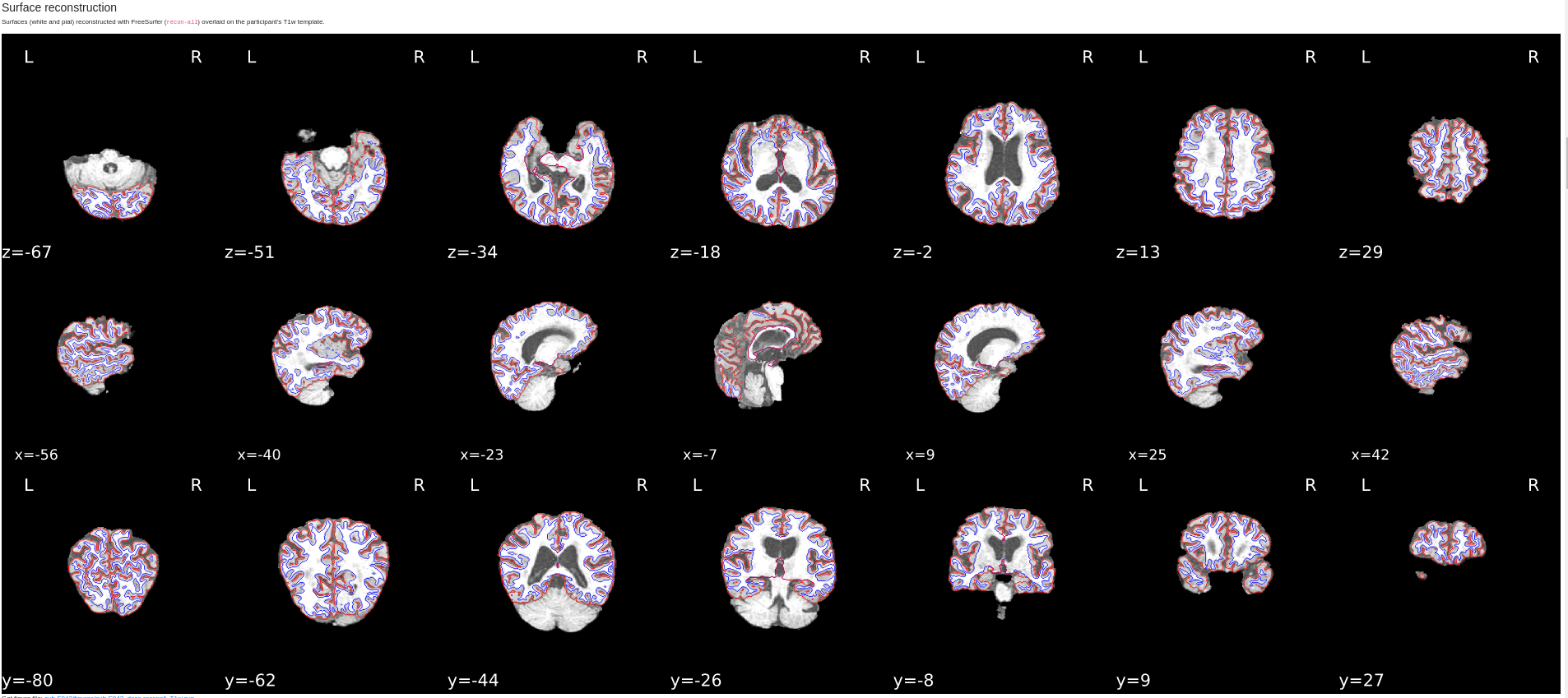 Failed Normalization of BOLD · Issue #2410 · nipreps/fmriprep · GitHub