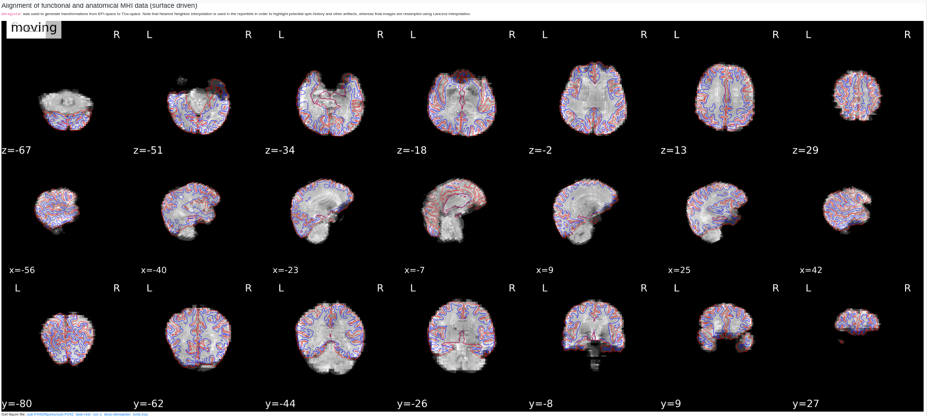 Failed Normalization of BOLD · Issue #2410 · nipreps/fmriprep · GitHub