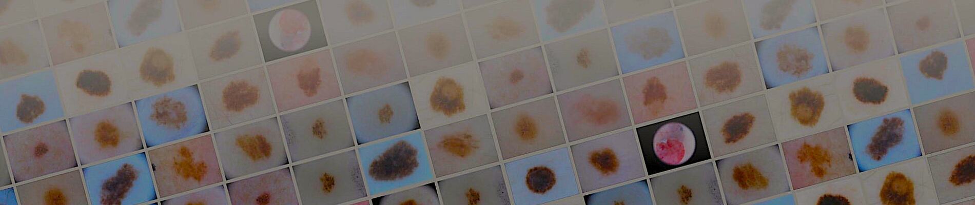 GitHub - hewramanwaran/Melanoma-Classifier-e12: My solution and submission to the SIIM-ISIC ...