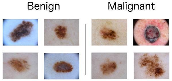 GitHub - hewramanwaran/Melanoma-Classifier-e12: My solution and submission to the SIIM-ISIC ...