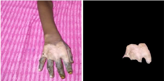 GitHub - aniram007/Burn-Degree-Analysis: This involves analyzing the ...