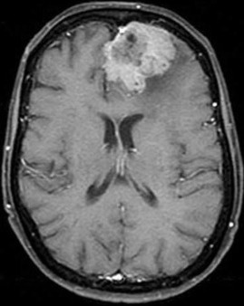 GitHub - bhattin82/Brain-Tumor-Detection-Machine-Learning-Model: A ...