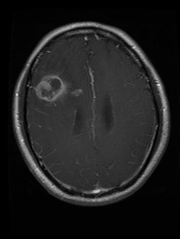 GitHub - bhattin82/Brain-Tumor-Detection-Machine-Learning-Model: A ...