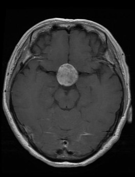 GitHub - bhattin82/Brain-Tumor-Detection-Machine-Learning-Model: A ...