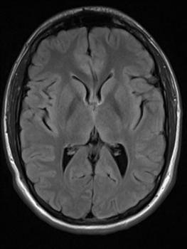 GitHub - bhattin82/Brain-Tumor-Detection-Machine-Learning-Model: A ...