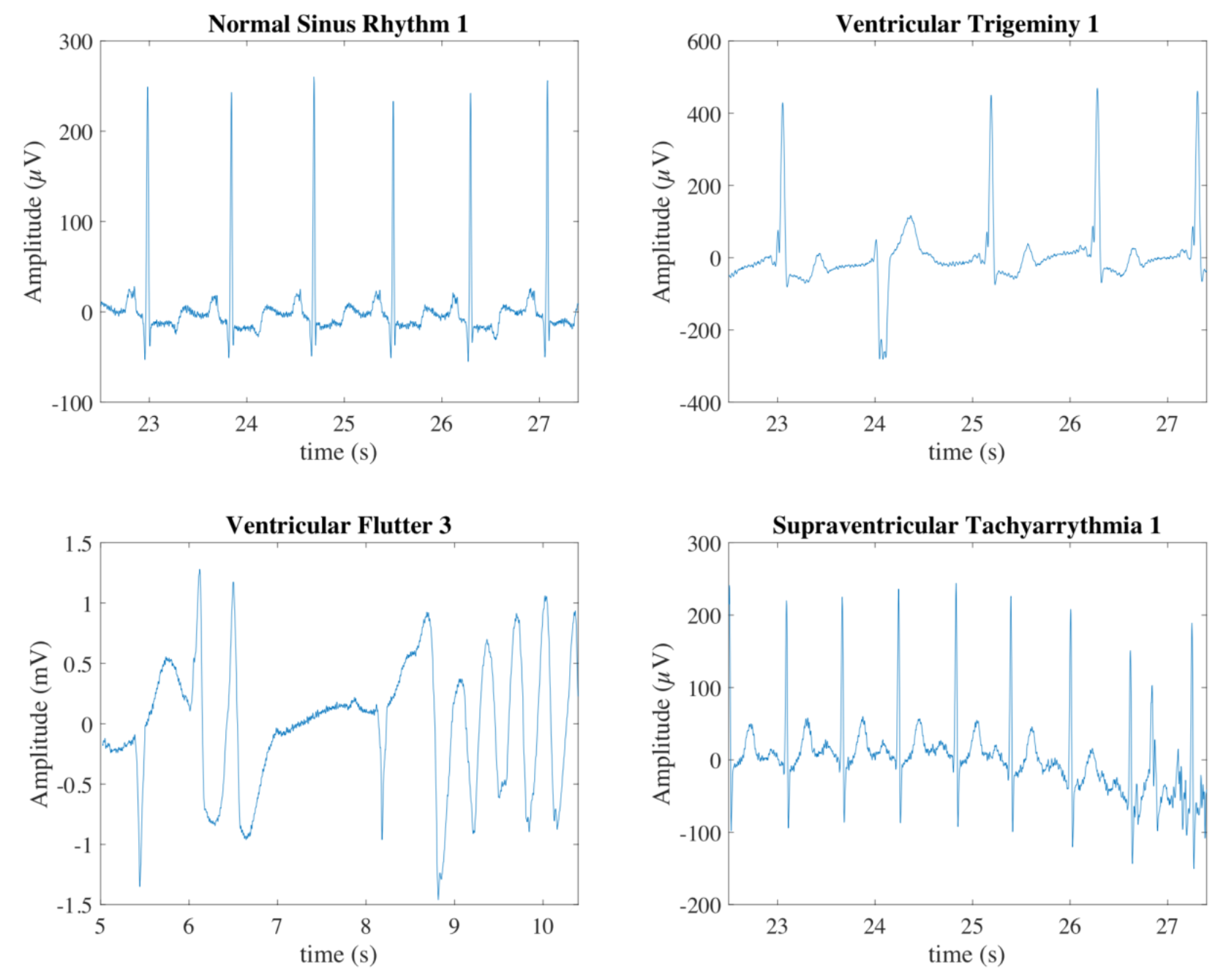 GitHub - treastorgavin/Biosignals_ECG_signalprocessing