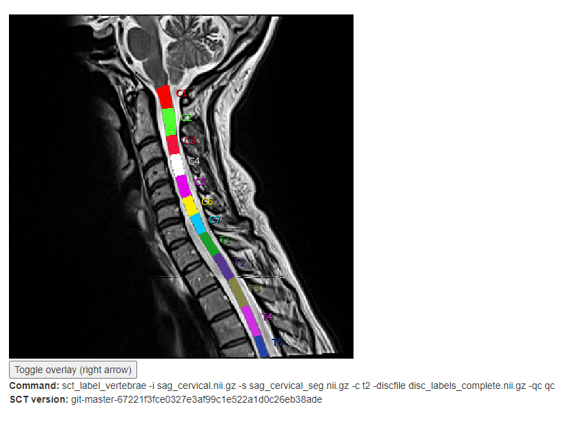 Wrong visualization of vertebral levels on the QC · Issue #3529 · spinalcordtoolbox ...