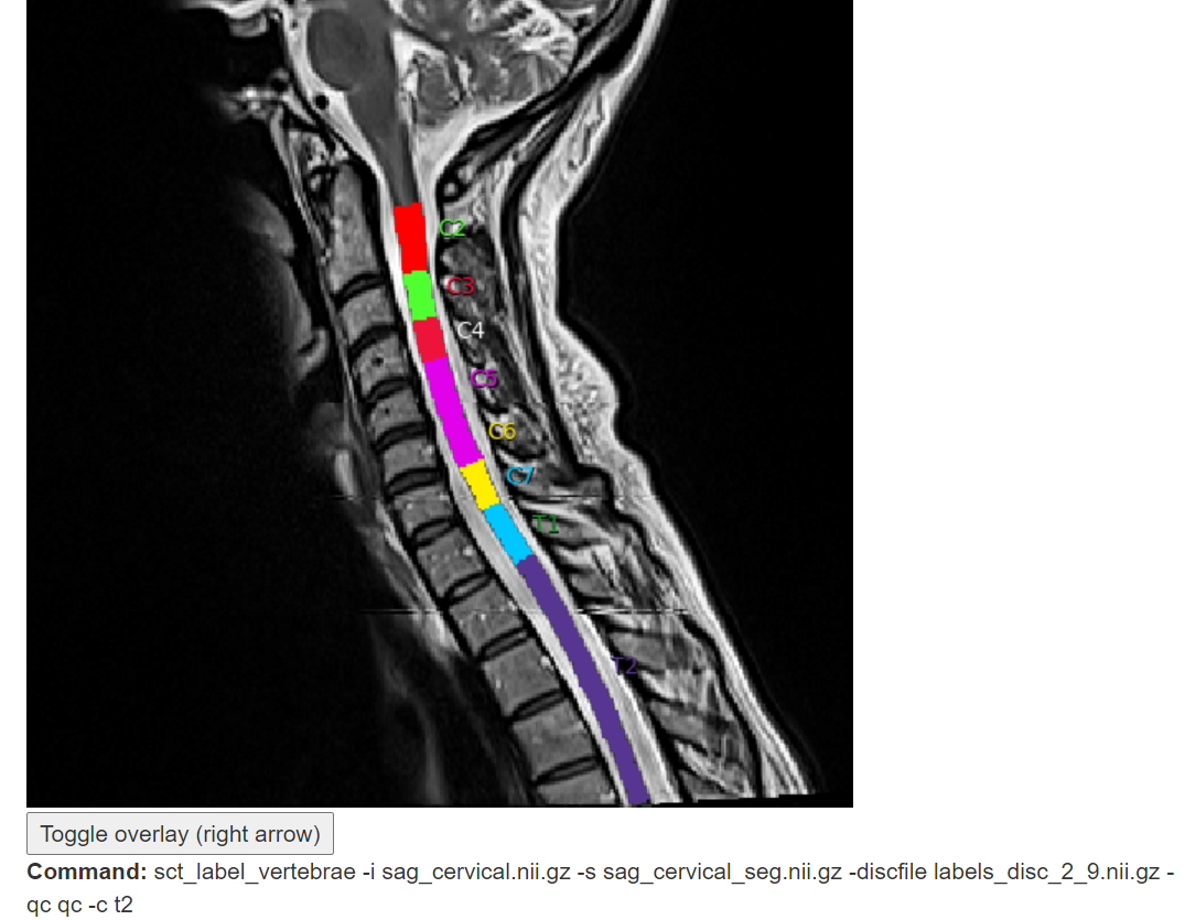 Wrong visualization of vertebral levels on the QC · Issue #3529 · spinalcordtoolbox ...