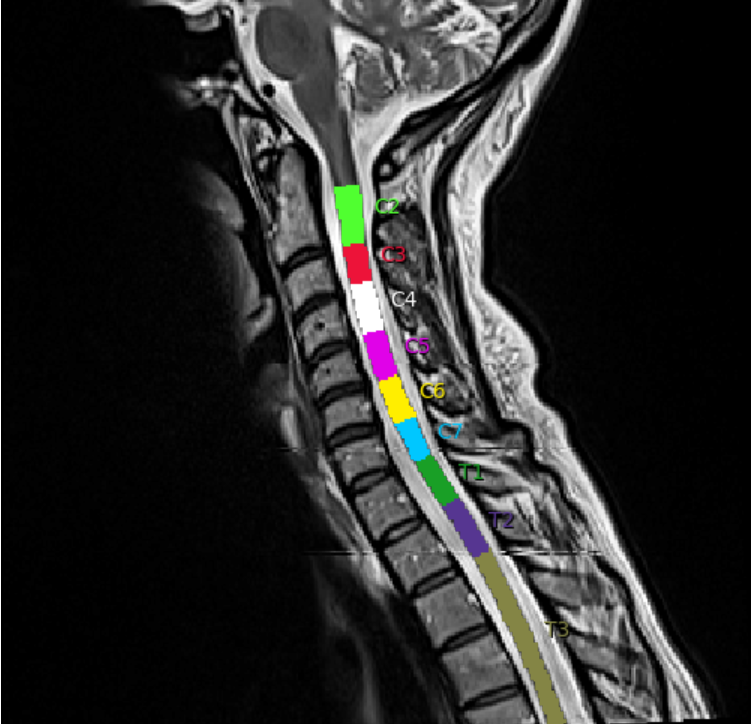 Wrong visualization of vertebral levels on the QC · Issue #3529 · spinalcordtoolbox ...