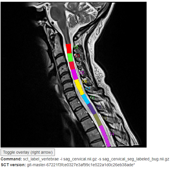 Wrong visualization of vertebral levels on the QC · Issue #3529 · spinalcordtoolbox ...
