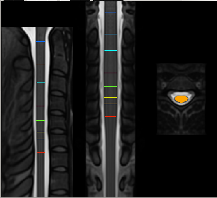 Intervertebral foramen to caudal and rostral rootlets to update spinal levels: limitations ...