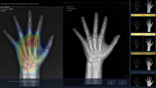 GitHub - km2000-stu/boneage_measurement