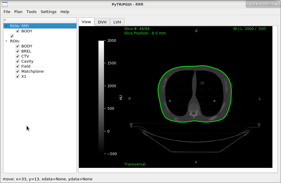 dicom2trip rtss: some DICOM structures are missing in VDX file. · Issue #457 · pytrip/pytrip ...