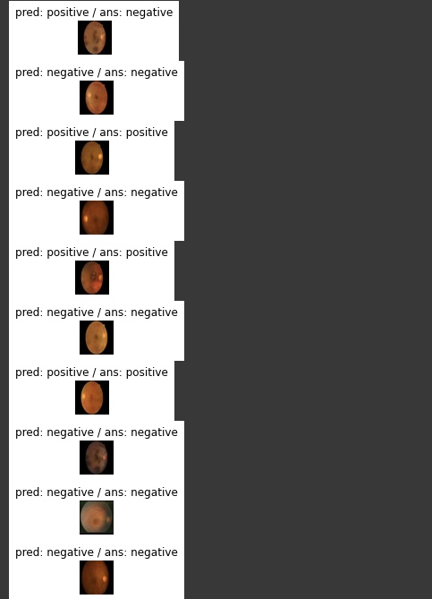 GitHub - insightp25/pytorch_fundus_discrimination_ai: 전이학습을 활용한 안저질환 자동판별 합성곱 신경망 모델