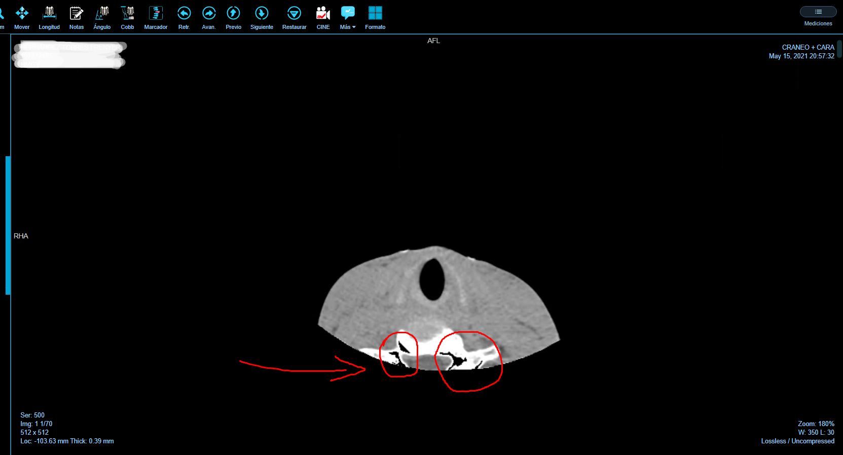 Images are displayed in black in OHIF viewer 2.0. Unsupported orthanc ...