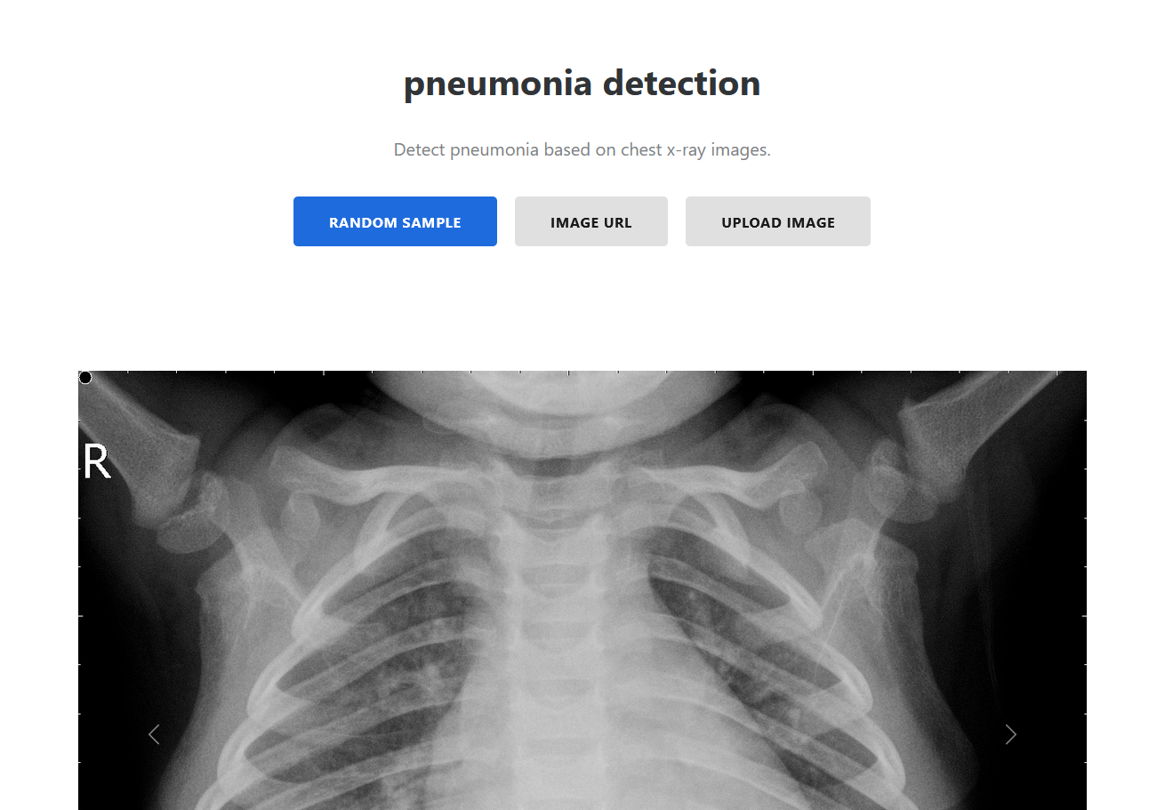 GitHub - np31121/pneumonia-detection: Computer-aided diagnosis system ...
