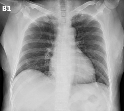 GitHub - AbdullahKhan47/Detection-of-Pneumonia-Through-Chest-X-Ray ...