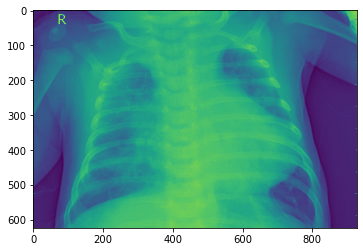 GitHub - ek775/Pediatric_Pneumonia_CXR_CNN: Phase 4 project for ...