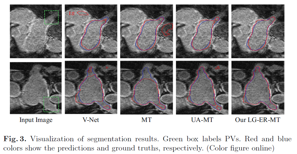 Local and Global Structure-Aware Entropy Regularized Mean Teacher Model for 3D Left Atrium ...