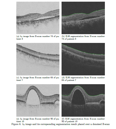 Inner limiting membrane segmentation and surface visualization method ...