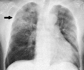 GitHub - parham2013/Pneumonia-Classification-PyTorch