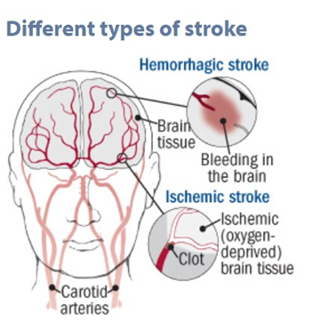 GitHub - onggreat/Stroke-Prediction