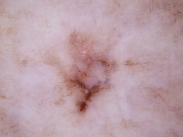 GitHub - OscarC9912/Skin_Cancer_Detect_w_CNN_ViT