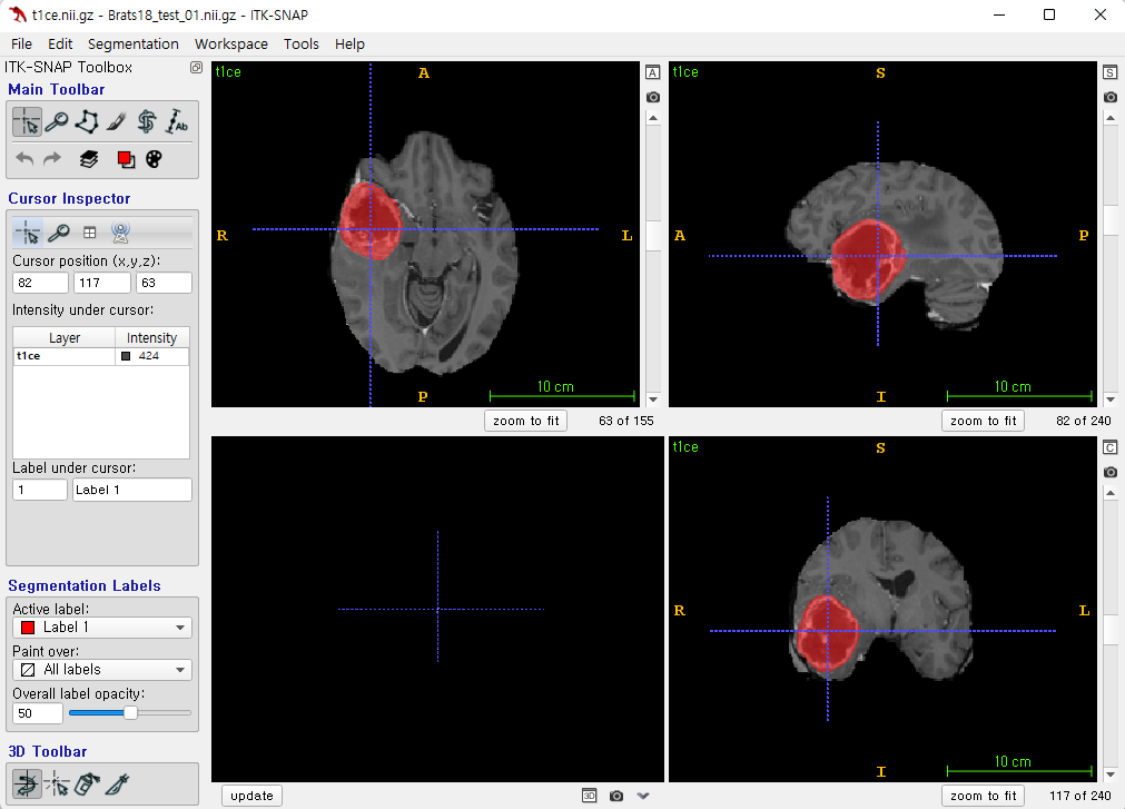 GitHub - leejooan/tumor_segmentation: Algorithm that can automatically ...