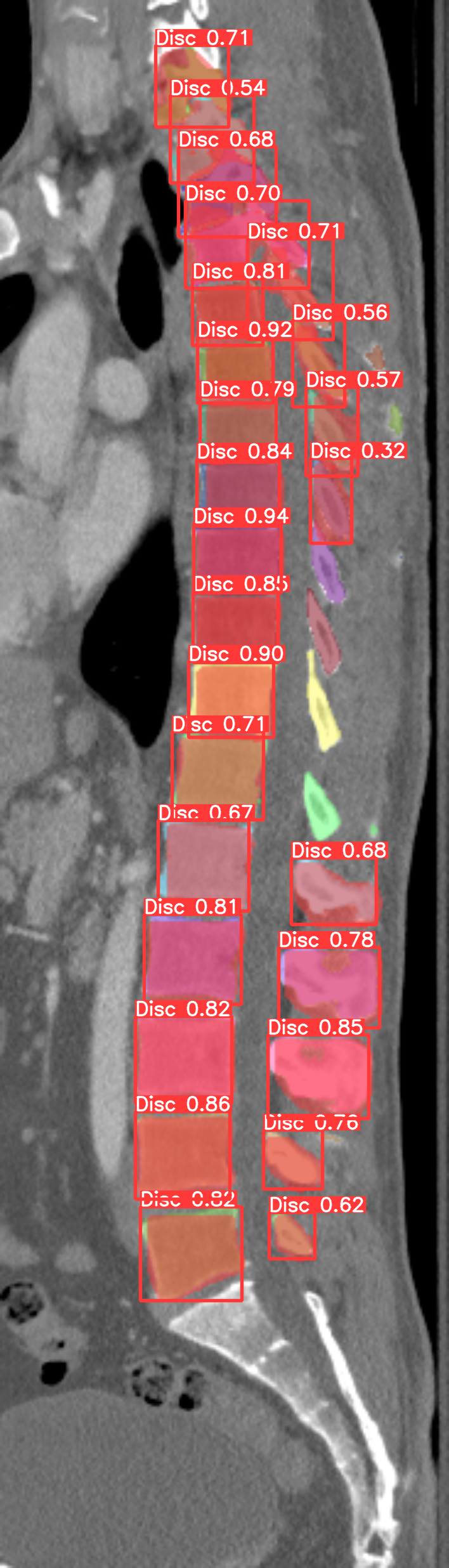 GitHub - KMH15/Spine-Segmentation-and-Vertebrae-Localization-using-YOLOv8