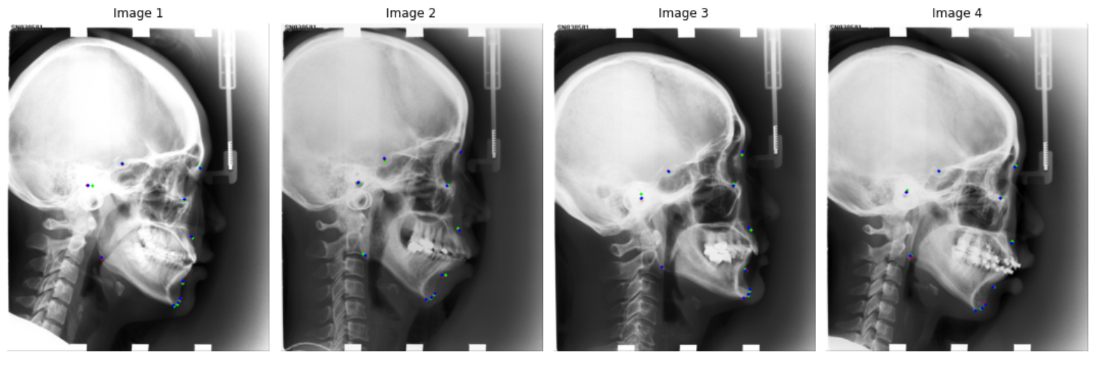 Github Bansangsu Automatic Cephalometric Landmark Detection