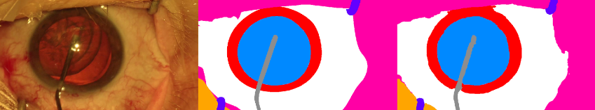 Github Congyoua Cataract Surgery Segmentation Cataract Surgery Segmentation Using