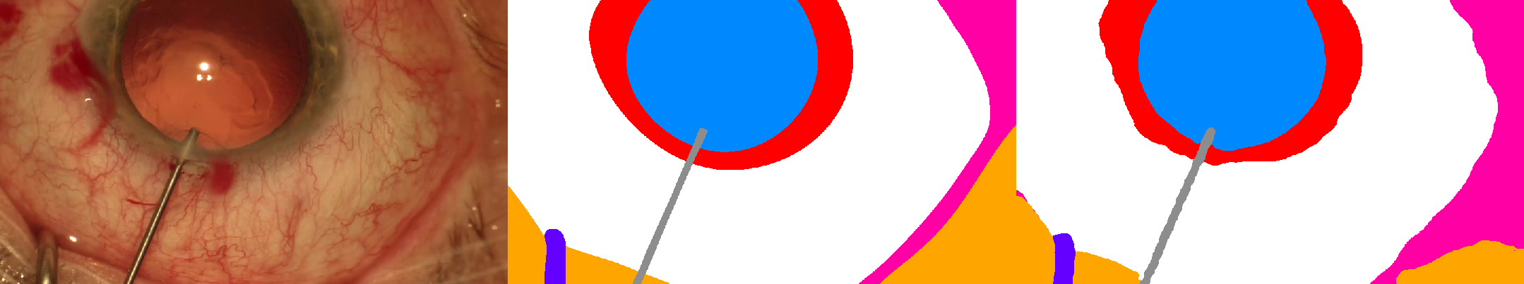 GitHub - congyoua/Cataract-surgery-segmentation: Cataract surgery segmentation using ...