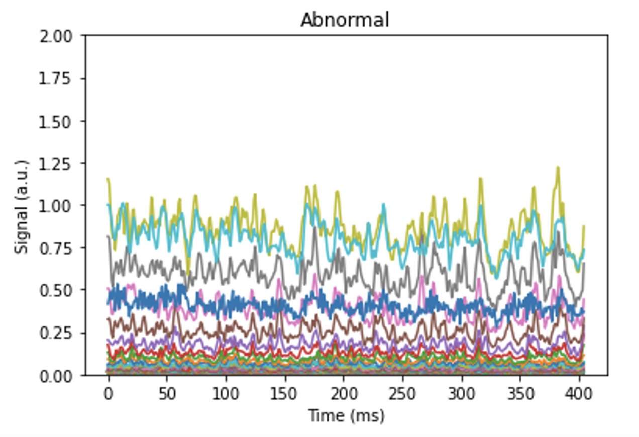 GitHub - PriyamvadaKumar/Heart-Beat-Anomaly-Detection-: Anomaly detection in heart beat data