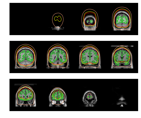 bem model and source estimate · Issue #2740 · mne-tools/mne-python · GitHub