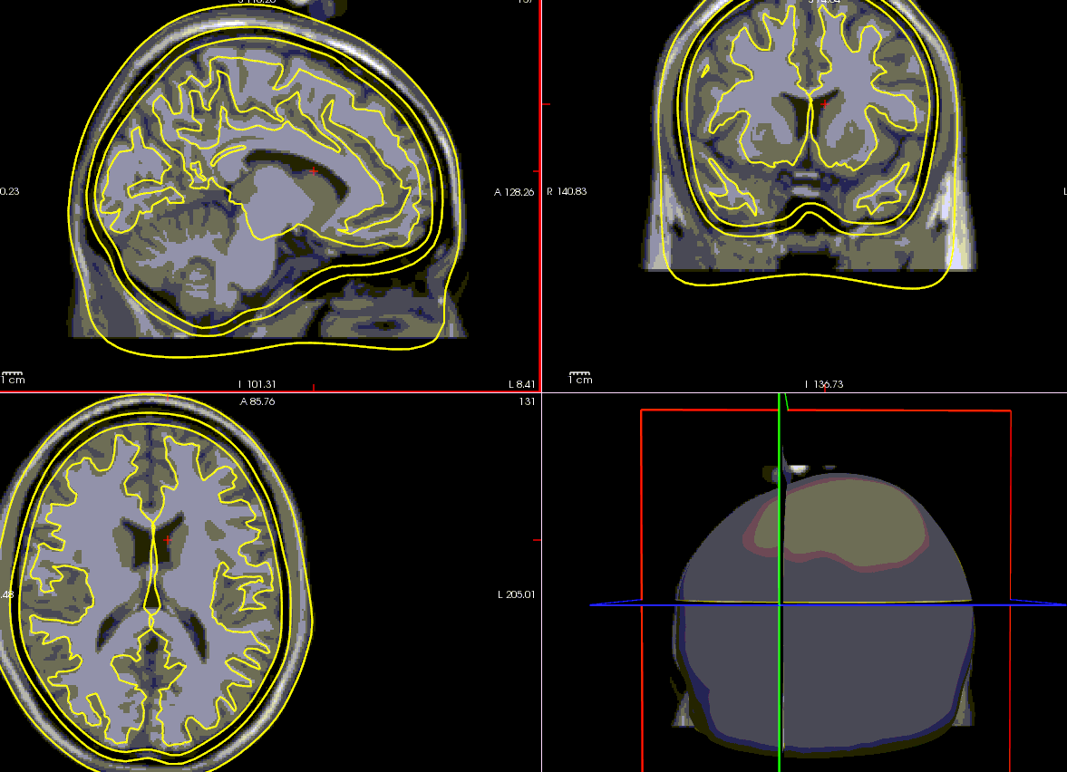bem model and source estimate · Issue #2740 · mne-tools/mne-python · GitHub