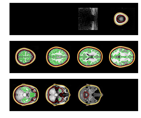 bem model and source estimate · Issue #2740 · mne-tools/mne-python · GitHub