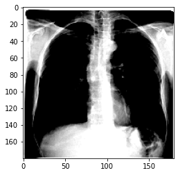 GitHub - eslamzidan/tuberculosis-detector-using-CNN-