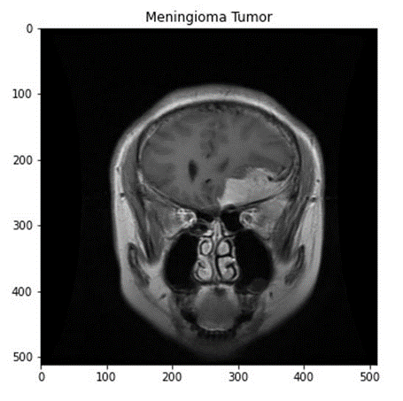 GitHub - ahmedshahjahan/Data-Science-Capstone-Project-Brain-Tumor ...