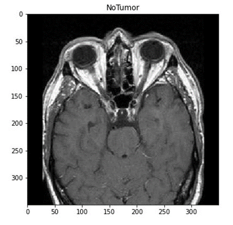 GitHub - ahmedshahjahan/Data-Science-Capstone-Project-Brain-Tumor ...