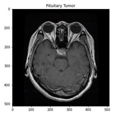 GitHub - ahmedshahjahan/Data-Science-Capstone-Project-Brain-Tumor ...