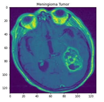 GitHub - ahmedshahjahan/Data-Science-Capstone-Project-Brain-Tumor ...