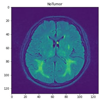 GitHub - ahmedshahjahan/Data-Science-Capstone-Project-Brain-Tumor ...
