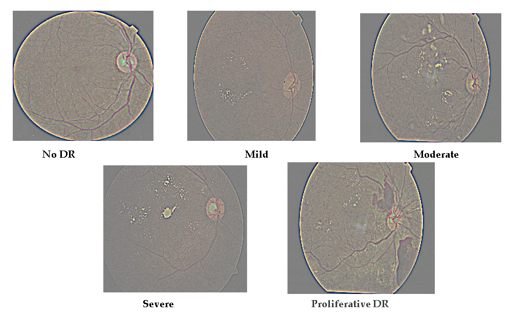 GitHub - theCodingEvolution/Diabetic-Retinopathy: Transfer Learning for ...