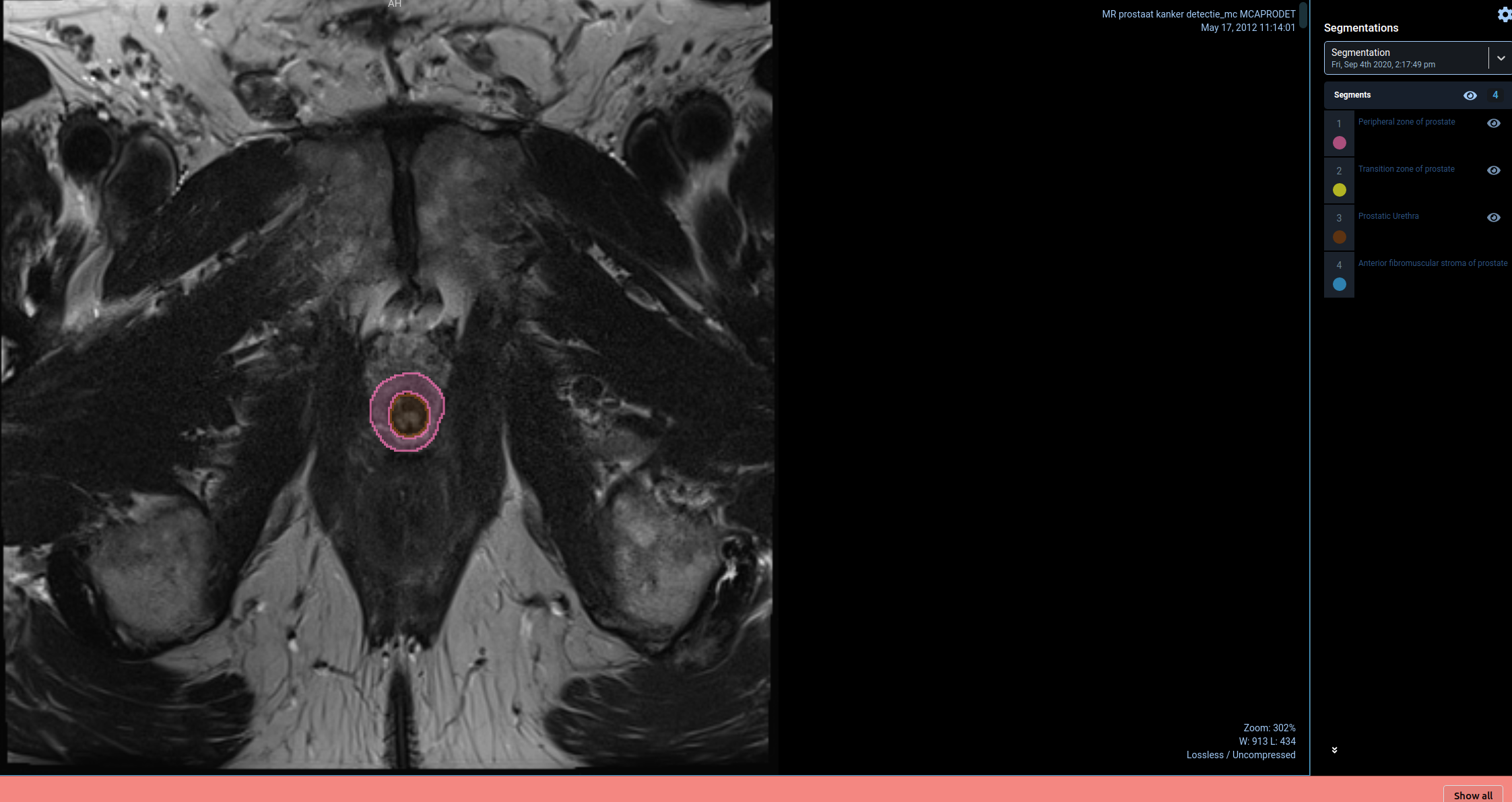 Failure to load segmentation · Issue #2345 · OHIF/Viewers · GitHub