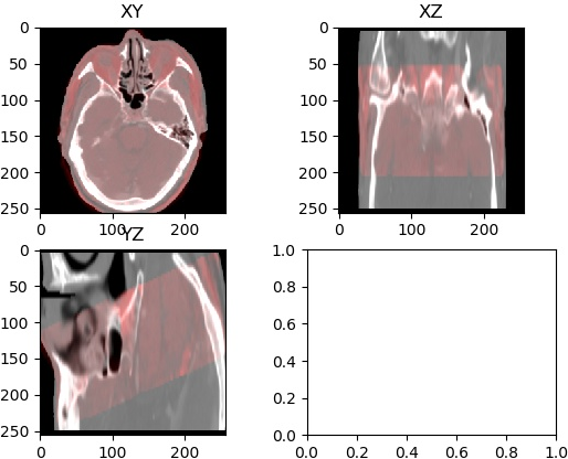 multi-modality (CT-MRI) image registration for Head and neck. · Issue #201 · voxelmorph ...