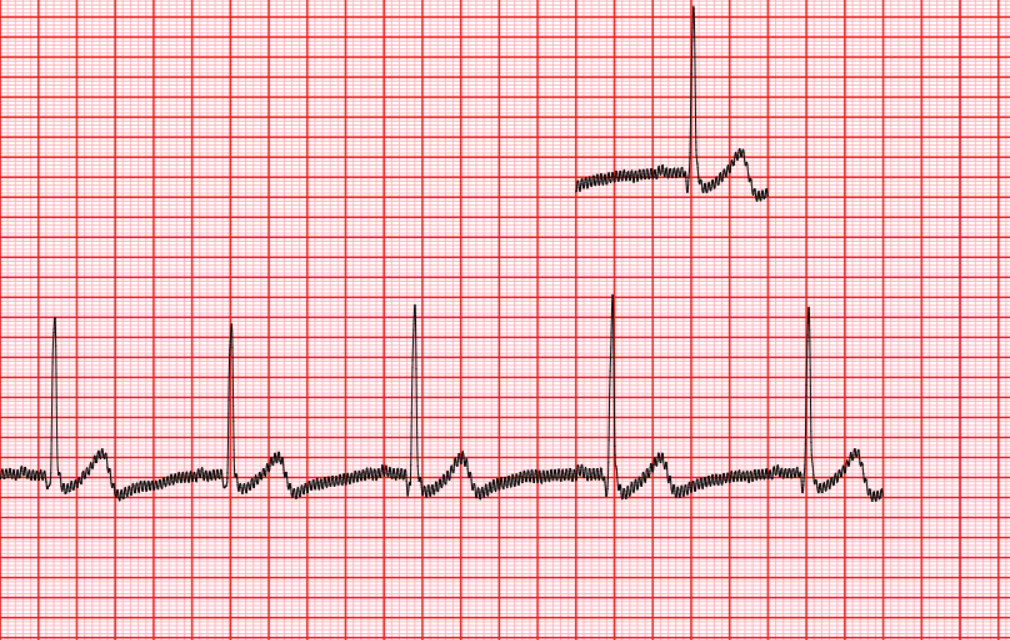Github Zhijie Heplot Ecg Using Opengl 1get The Dataset From Biosppy 2plot The Real Time