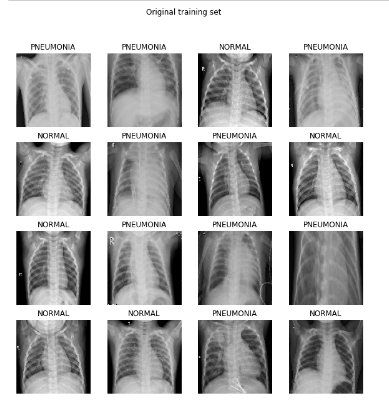 GitHub - eshita-jain/Chest_x-ray_pneumonia_detection