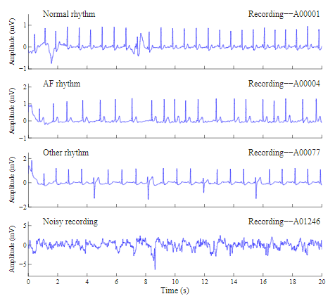 GitHub - georgios-kalomitsinis/Heartbeat-Classification: Classification ...