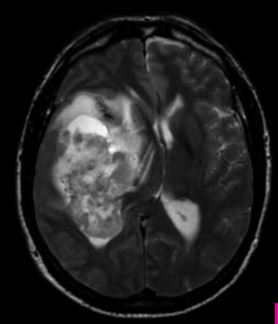 GitHub - Rakibur-Rahman/BrainTumerClassification