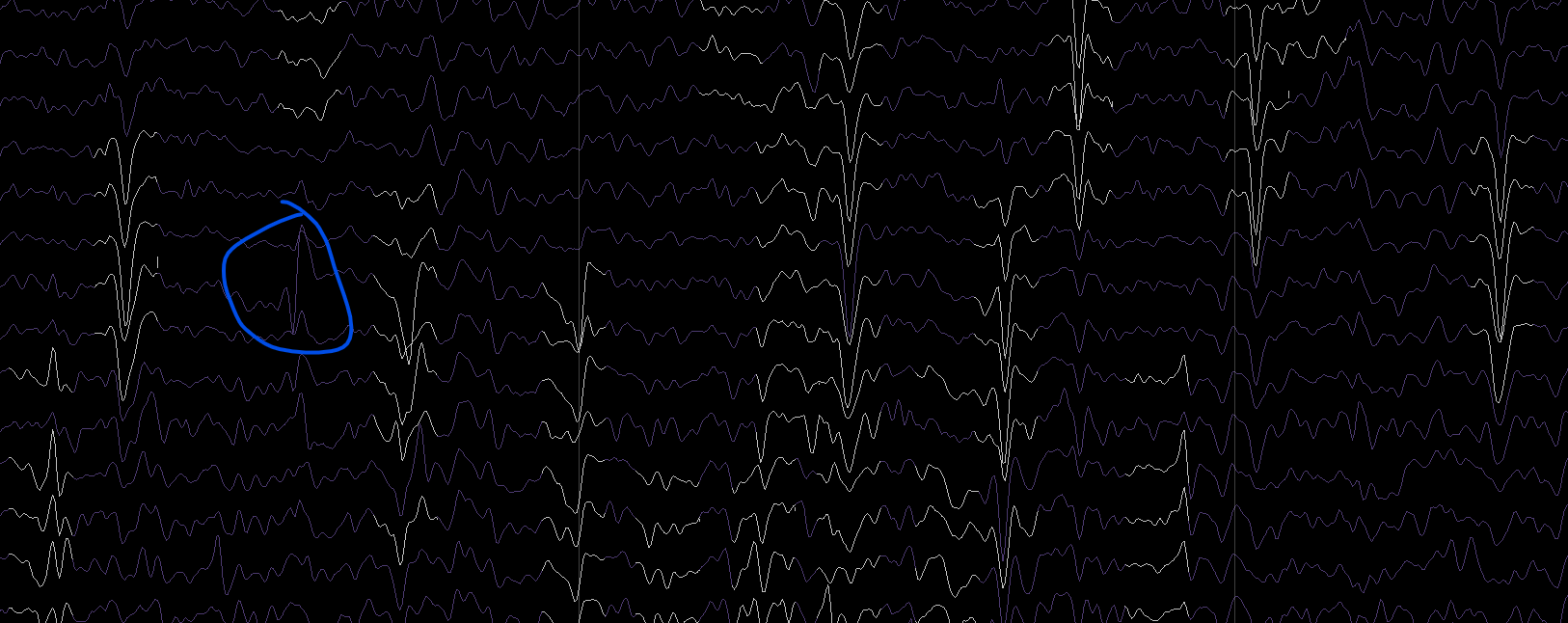 Complex spikes · Issue #536 · MouseLand/Kilosort · GitHub